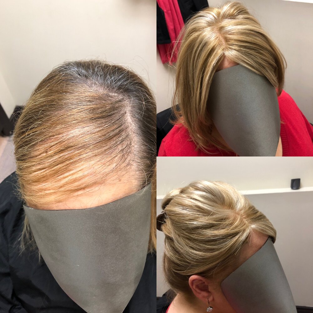 Alexis Hair Experts - hair loss, hair transplants, wigs, natural wigs ...